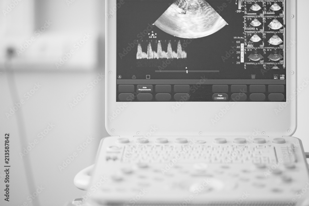 Photo of the ultrasound scanner screen depicting the sagittal scan of ...