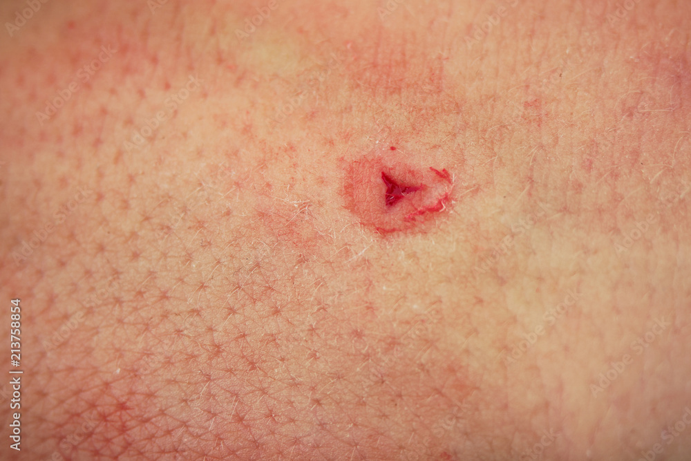 Medicinal Leech - Hirudo medicinalis - leech bite, typical triangle leech bite after sucking ...