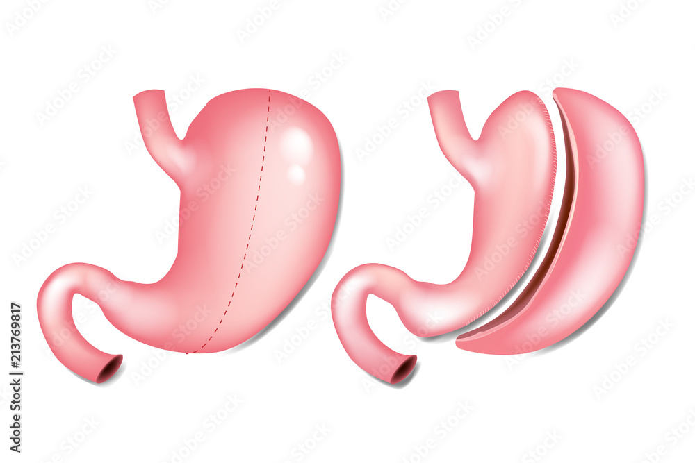 Laparoscopic Gastrectomy Gastric Sleeve (also known as the Greater ...