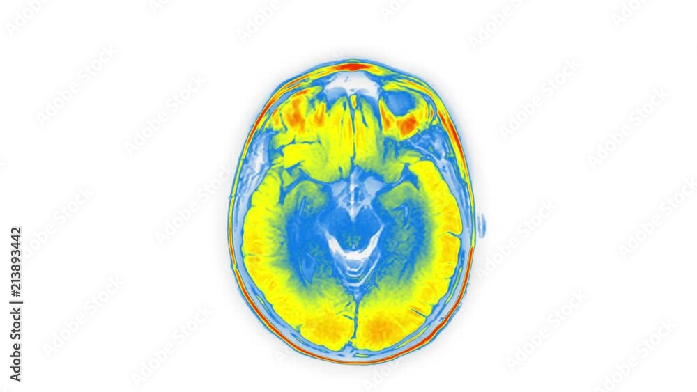 Computed medical tomography MRI upscaled scan of healthy young female ...