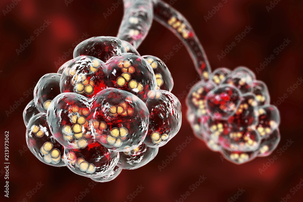 Pneumococcal pneumonia, medical concept. 3D illustration showing ...