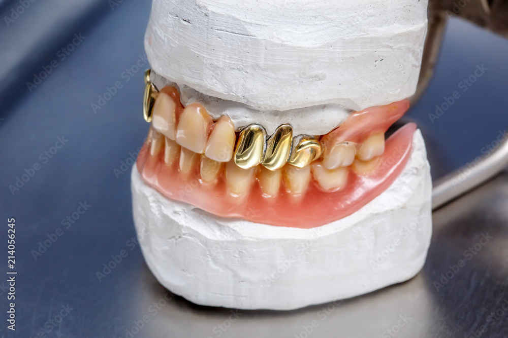Dental gold teeth prosthesis, clay mold human gums model Stock Photo ...