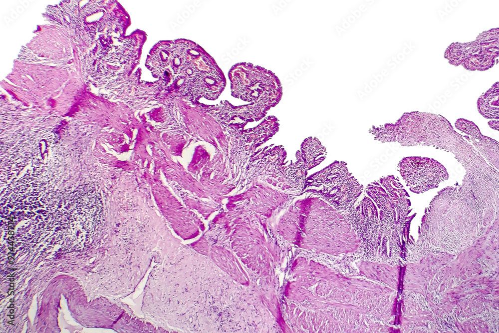 Chronic cholecystitis, light micrograph, photo under microscope showing ...