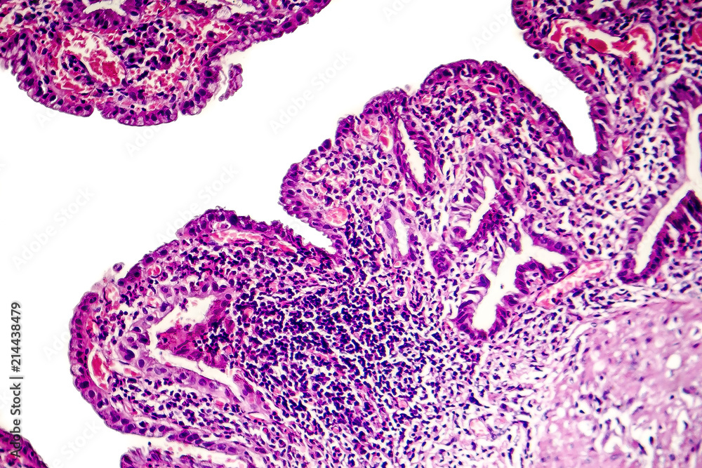 Chronic cholecystitis, light micrograph, photo under microscope showing ...