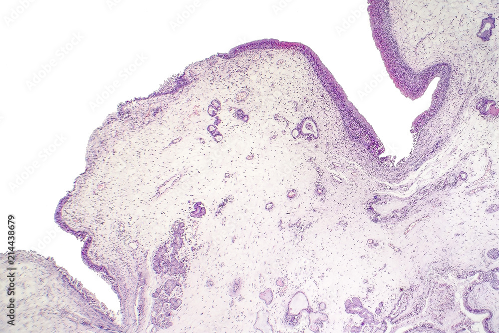 Inflammatory polyp, light micrograph, photo under microscope foto de ...