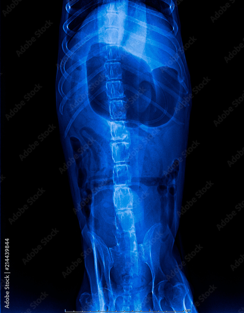 X-ray of dog anterior view with Gastric dilatation volvulus“GDV”or ...