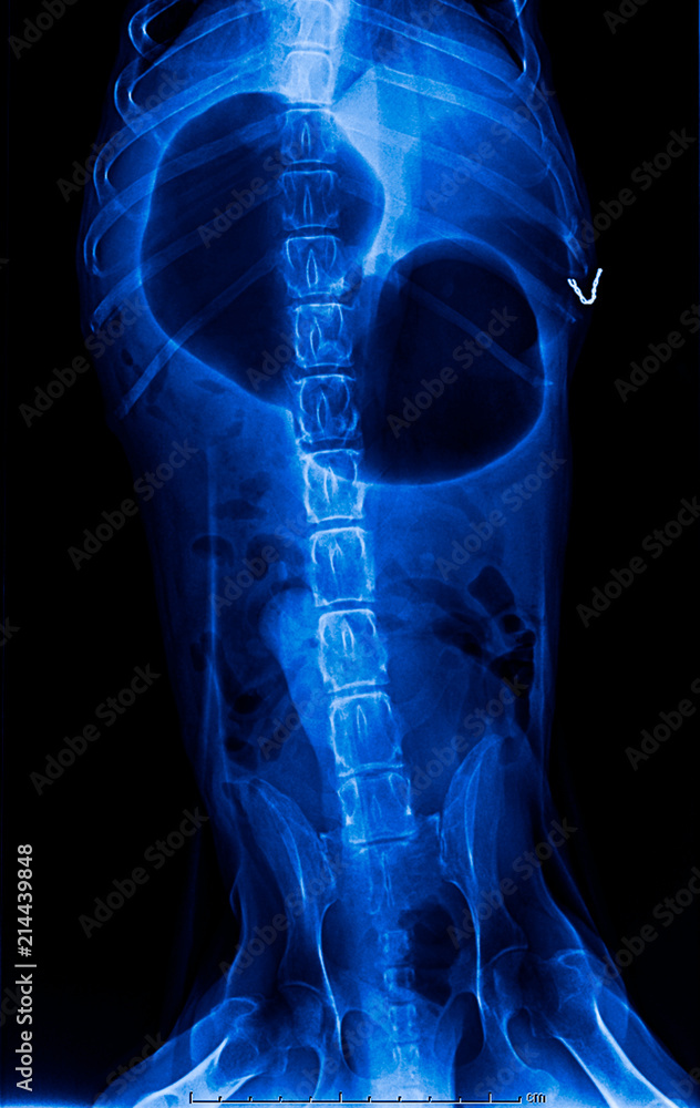X-ray of dog anterior view with Gastric dilatation volvulus“GDV”or ...