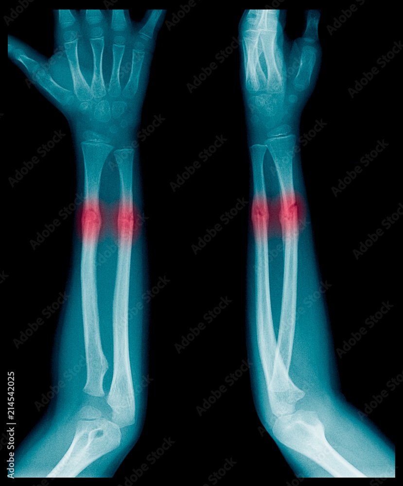 Ulna Bone Fracture