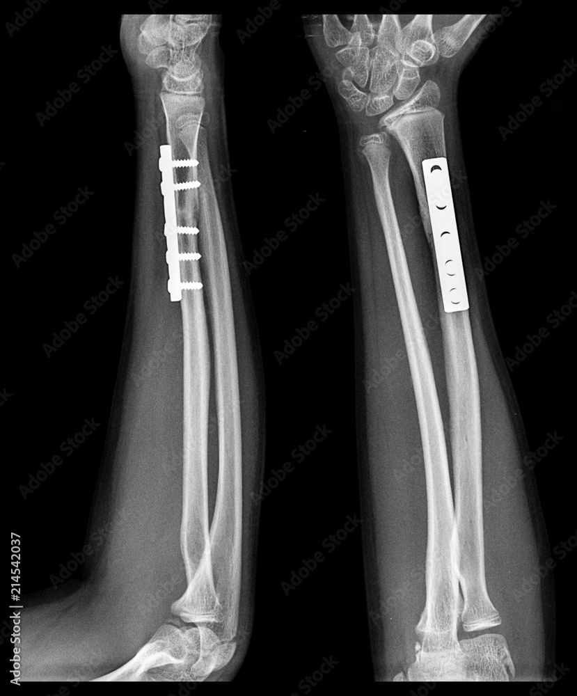 Fracture bones of forearm. Orthopedic surgeon operated and internal ...