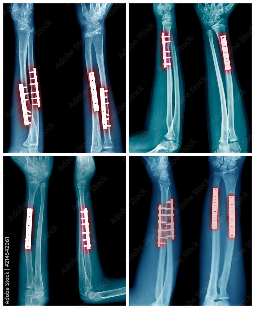 Fracture bones of forearm. Orthopedic surgeon operated and internal ...