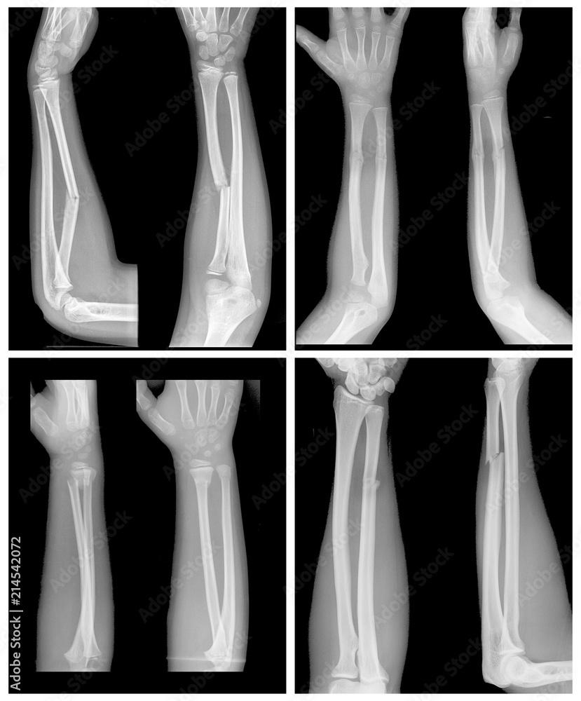 Collection of X-ray image of Forearm bone fracture in child's (Radius ...