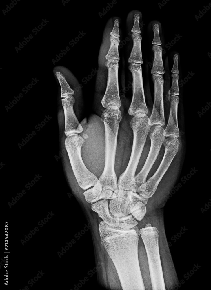 Hand Xray