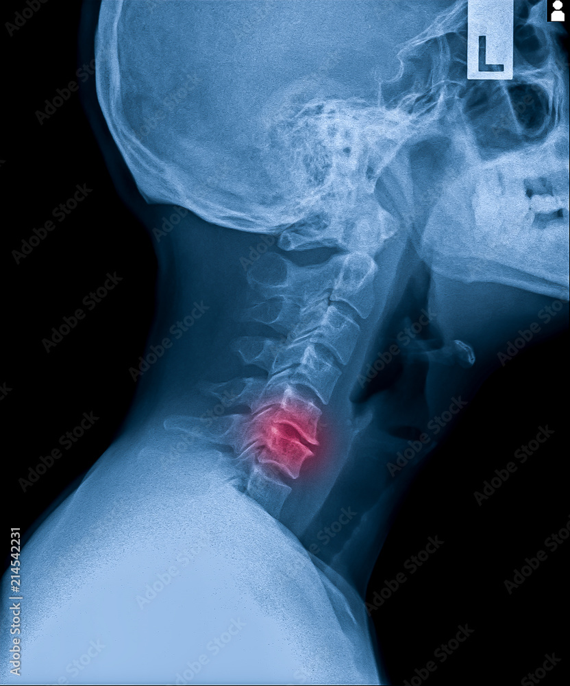 X-ray of neck and cervical spine side view. Image of radiography from ...