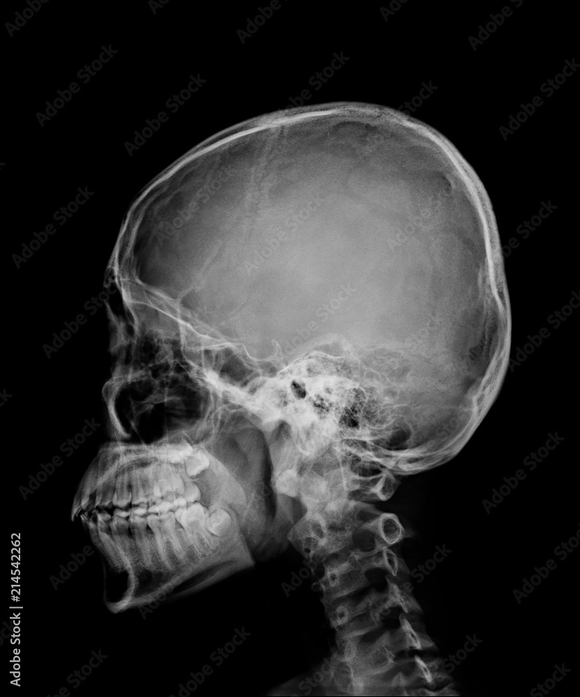 head skull x-ray side view Stock Photo | Adobe Stock