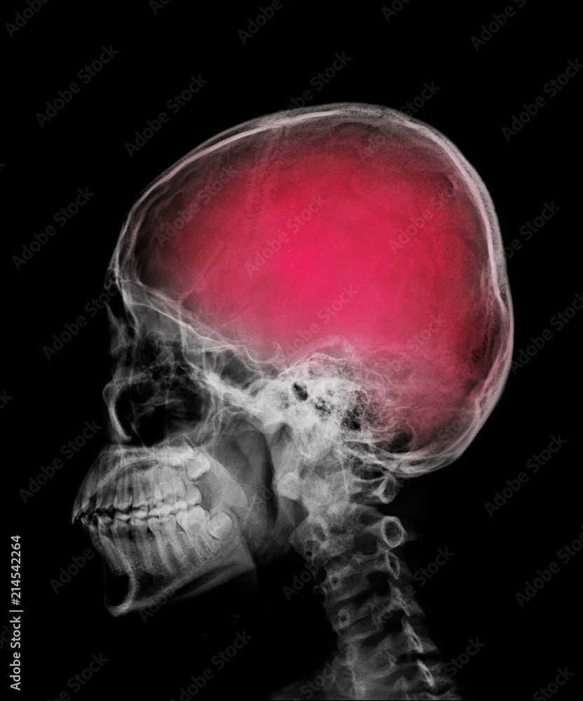 head skull x-ray side view and area of brain show in red color Stock ...
