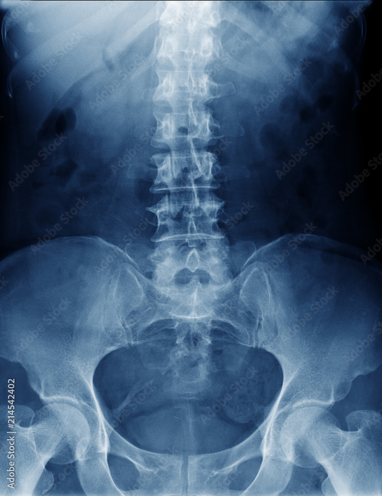 x-ray image of human normal spine, rips, pelvis, both hip joint Stock ...