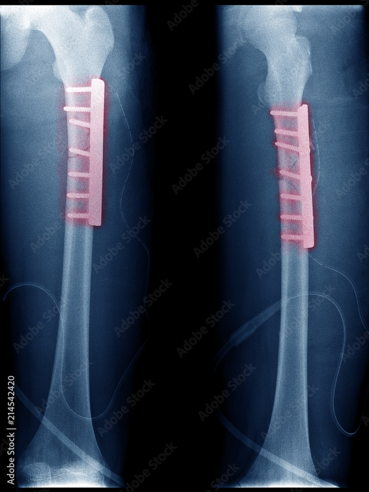 x-ray image of fracture femur bone , after reduction and internal ...