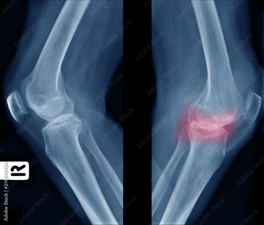 X-ray image show comparison of older normal knee on left side and ...