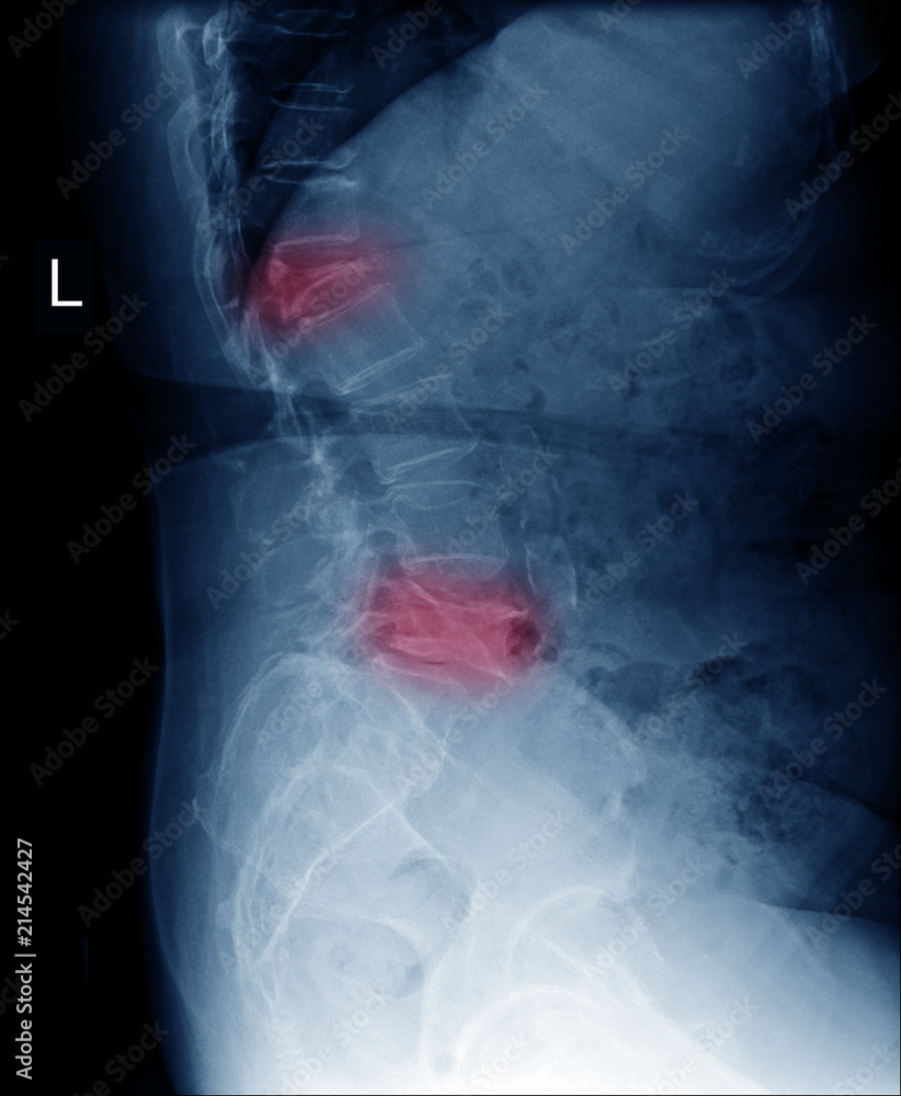 X-ray image side view of lumbar spines show deformity and compression ...