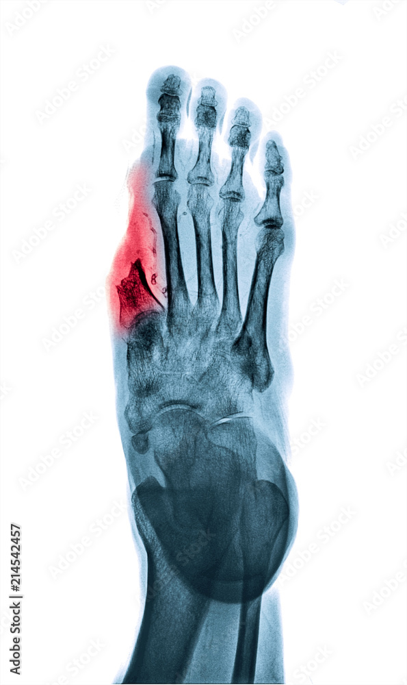 X-ray image of amputated big toe in diabetic patient. Reverse process ...