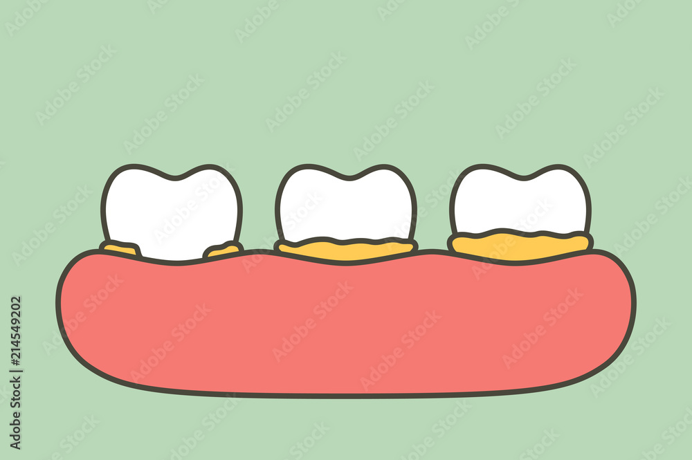 step of plaque or tartar , cause of tooth periodontal disease - dental ...