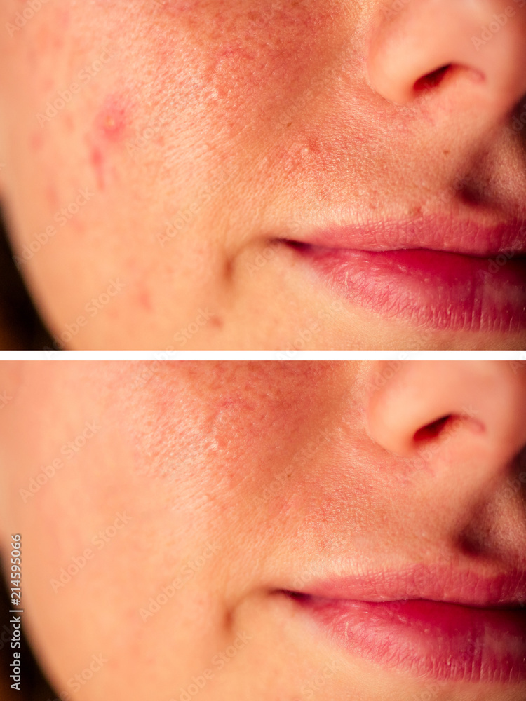 pimples on the skin of the girl close-up before after Stock Photo ...