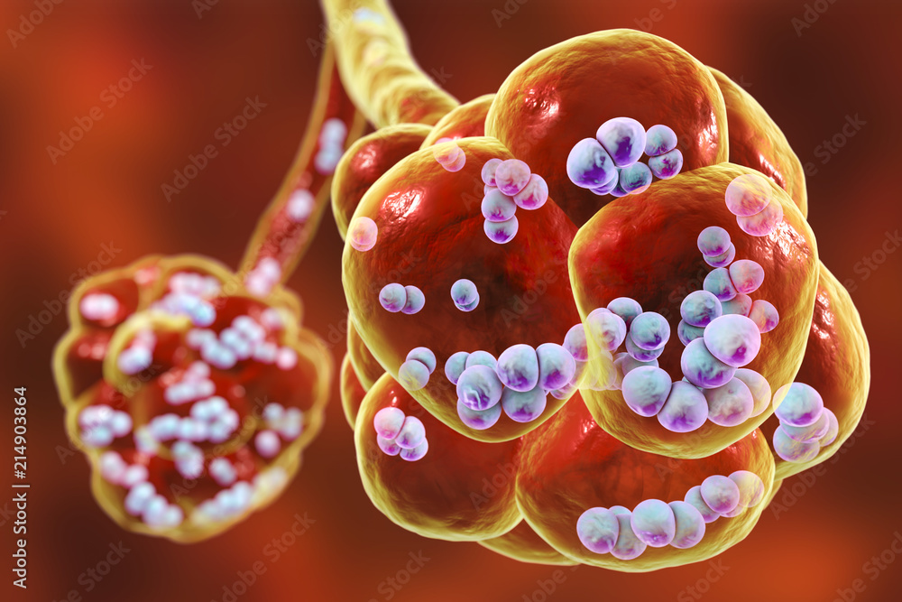 Pneumococcal pneumonia, medical concept. 3D illustration showing ...