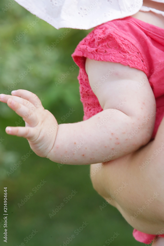 Baby rash caused by fever, insect bite, skin allergy or heat reaction ...