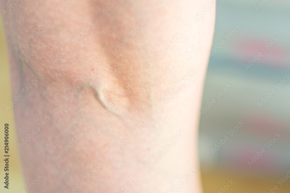 Varicose veins on the female leg. The initial stage of development of ...