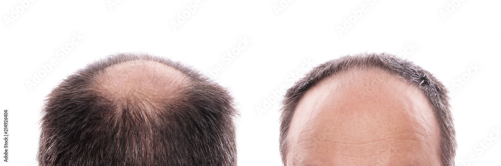 circular hair loss at the back of the head and receding hairline at the ...