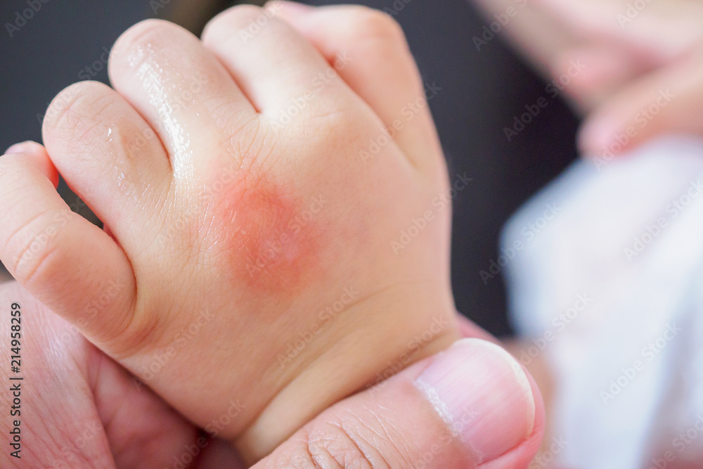 baby hand with skin rash and allergy with red spot cause by mosquito ...