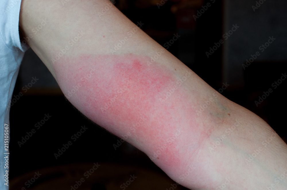 Bee Sting Allergic Reaction Arm