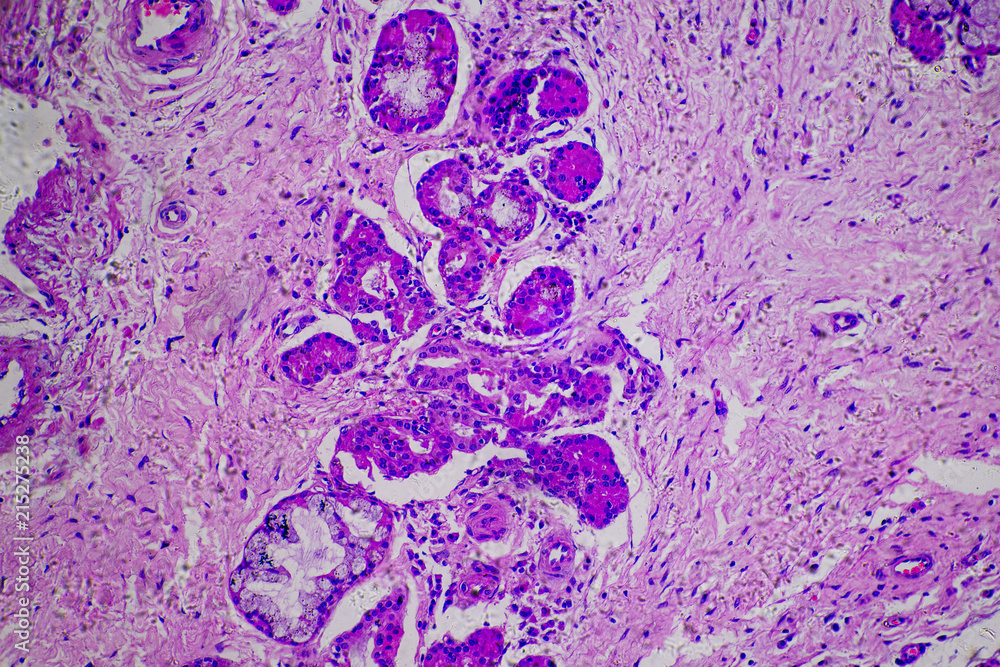 micrograph of human nasal polyp Stock Photo | Adobe Stock