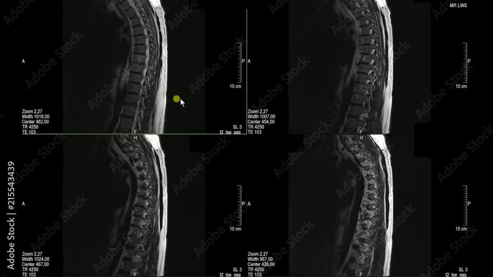 Real MRI Scan of Doctor examining the thoracic spine Stock Video ...