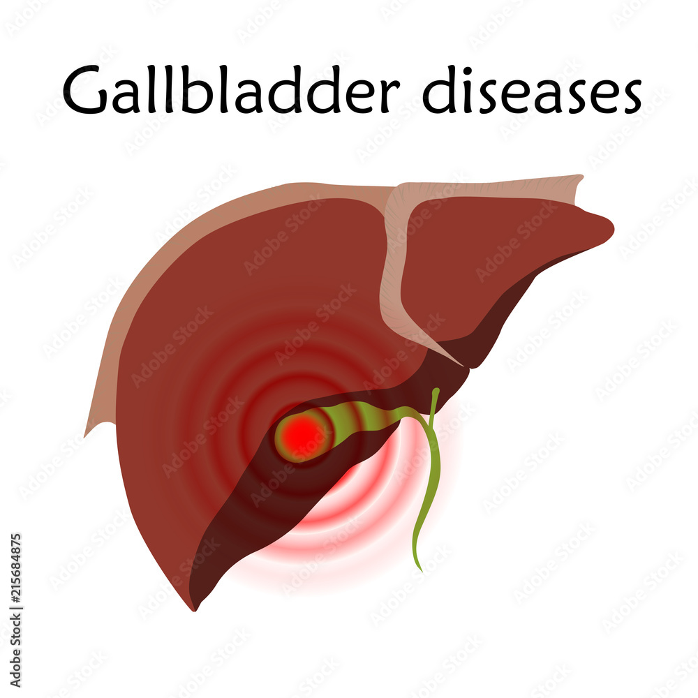 Gallbladder diseases, inflammation. Liver wit gallbladder. Anatomy ...