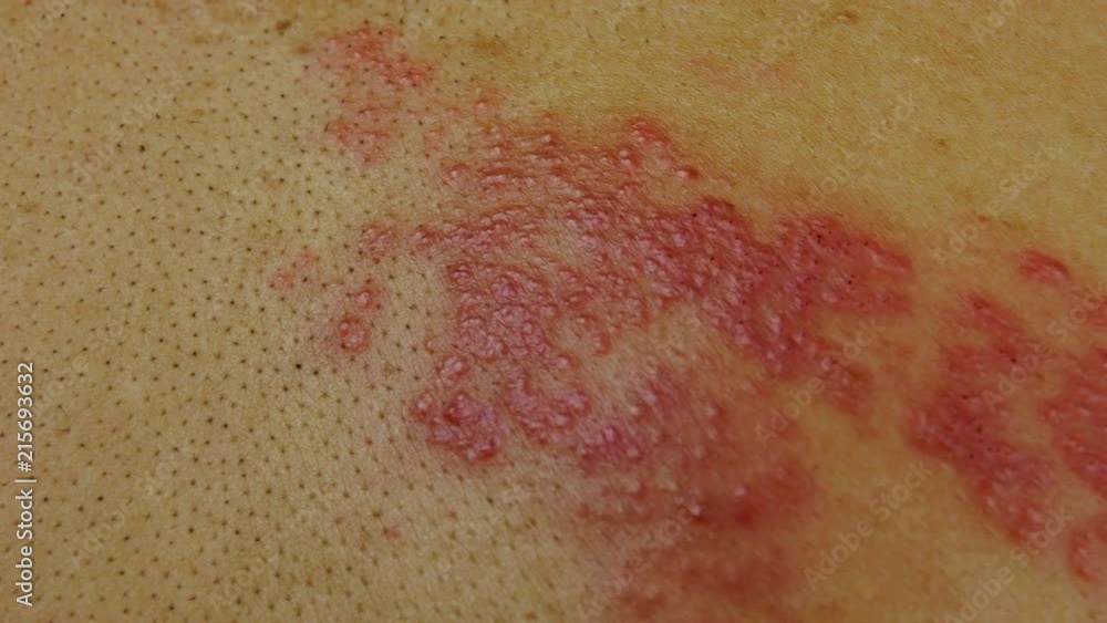 4k dolly shot, Herpes zoster skin disease caused by a virus that ...