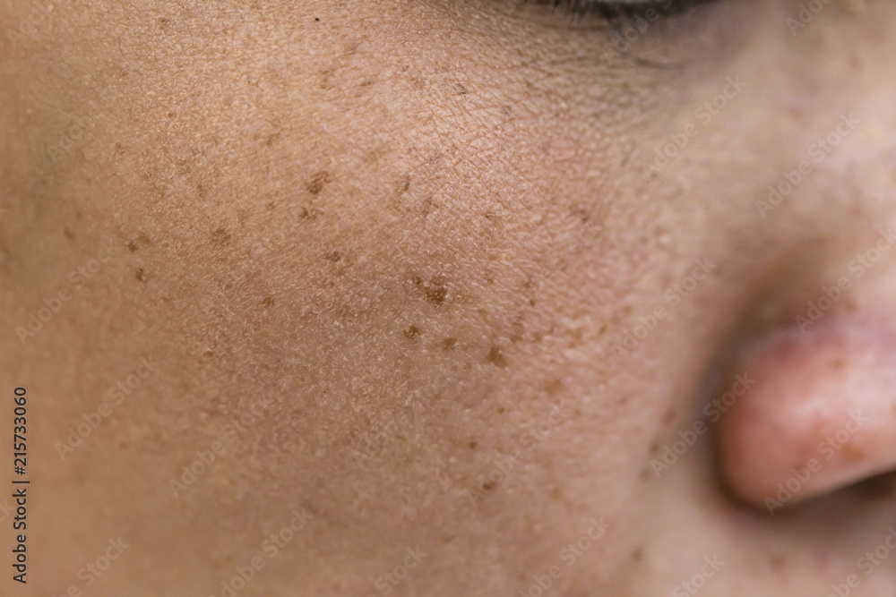 Skin Diseases On Face