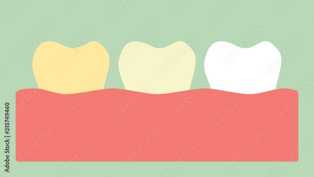 yellow to white tooth, teeth whitening concept - dental cartoon vector ...
