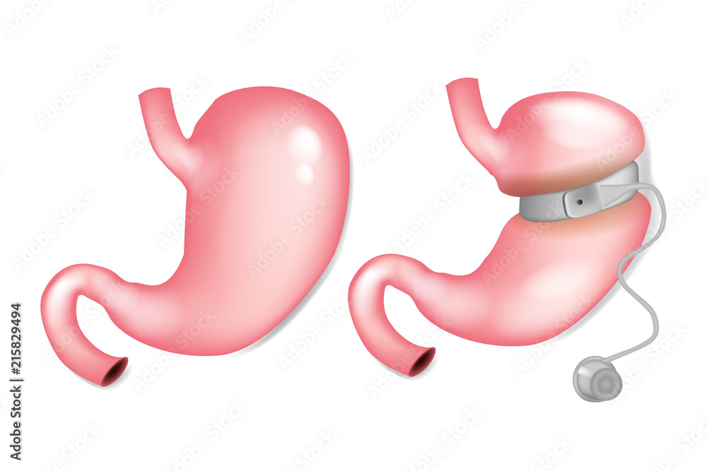 Gastric band before and after. Gastric Banding Surgery Stock Vector ...