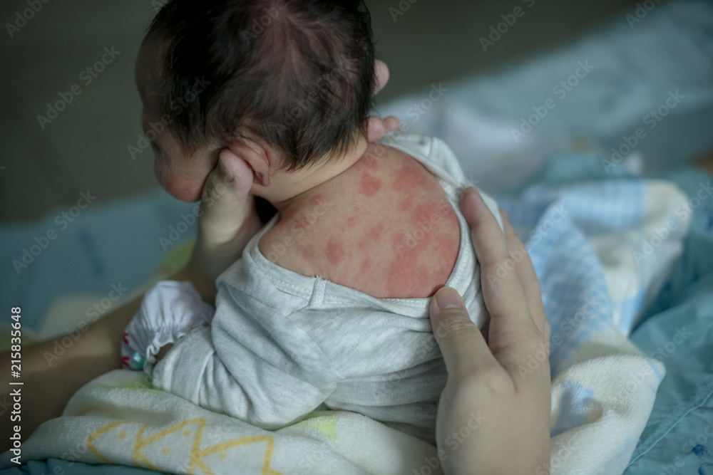 Common rash in newborn usually between 2-5 day after birth. (Erythema ...