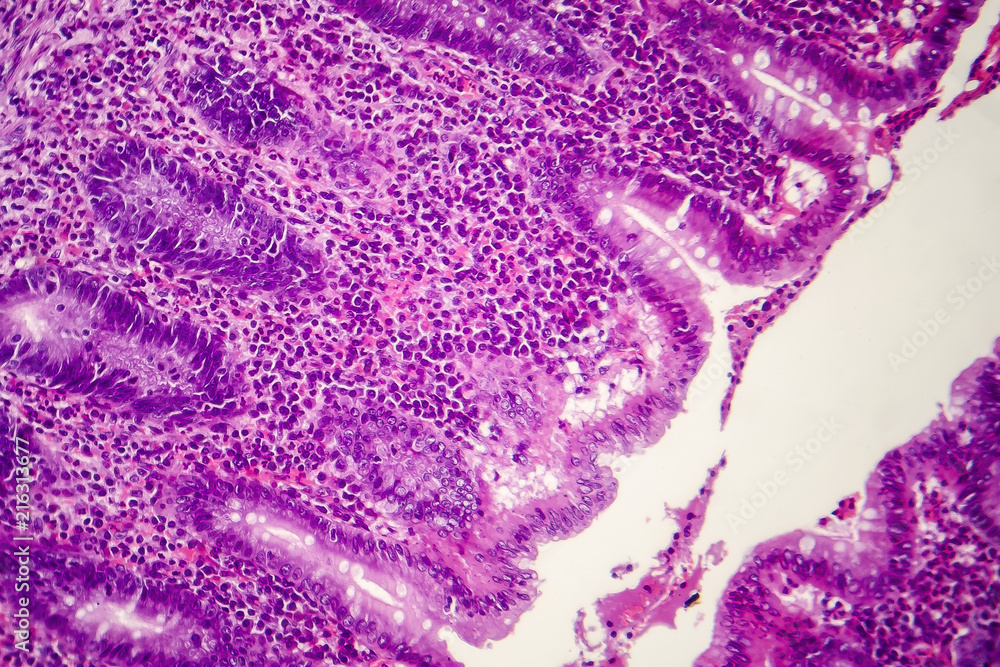 Suppurative appendicitis, light micrograph, photo under microscope ...