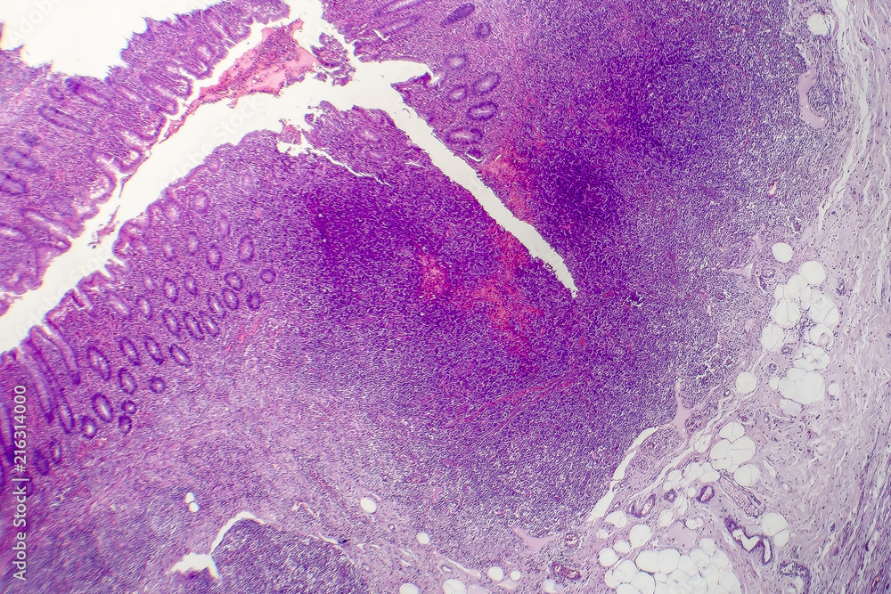 Suppurative appendicitis, light micrograph, photo under microscope ...