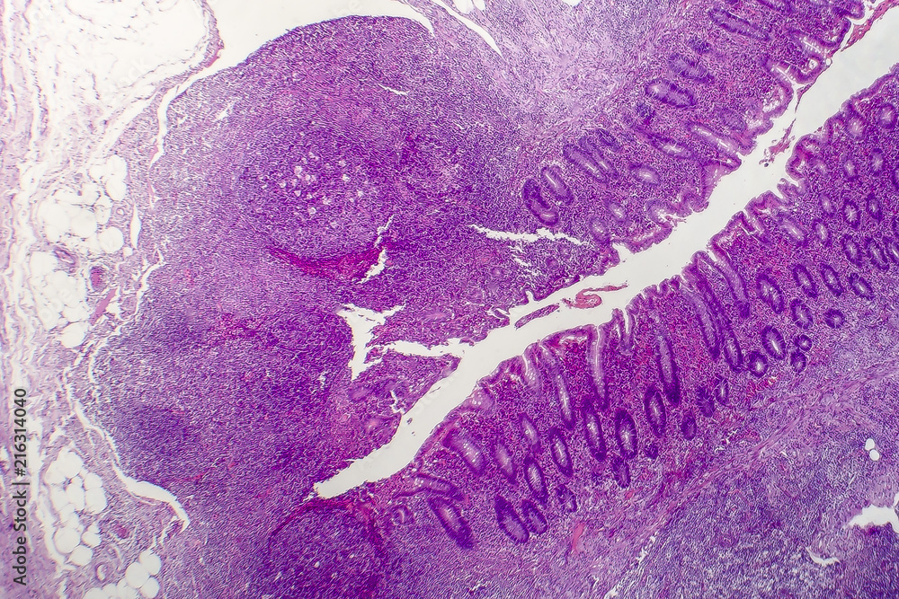 Suppurative appendicitis, light micrograph, photo under microscope ...