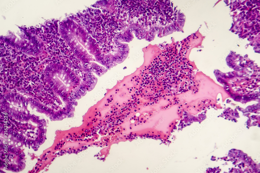 Suppurative appendicitis, light micrograph, photo under microscope ...