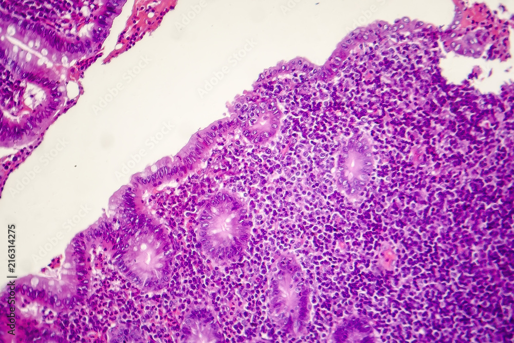 Suppurative appendicitis, light micrograph, photo under microscope ...