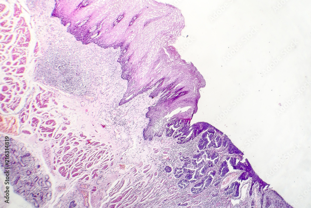 Squamous cell carcinoma, light micrograph, photo under microscope Stock ...