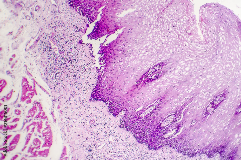Squamous cell carcinoma, light micrograph, photo under microscope Stock ...