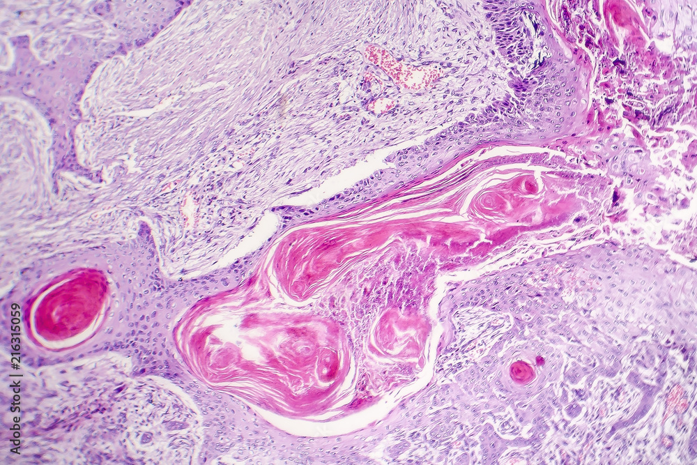 Squamous cell carcinoma, light micrograph, photo under microscope ...