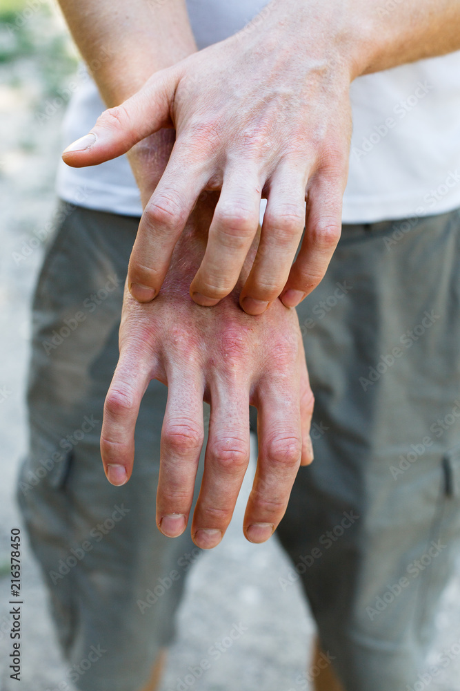 The problem of many people - eczema on hand. Street background. Man ...