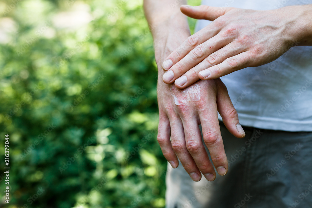 Ointment on hand. Applying the ointment in the treatment and hydration ...